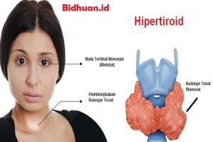 Penyebab Penyakit Hipertiroid - Homecare24